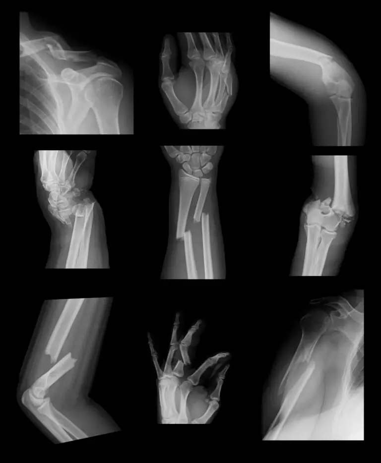 Common Types Of Bone Fractures Common Types Of Bone Fractures
